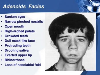 Adenoids face with text - Philadelphia Holistic Clinic