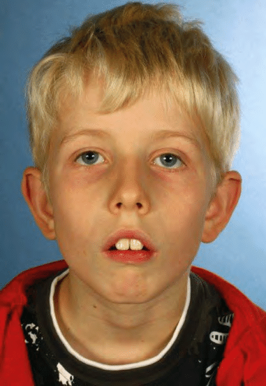 Adenoids face - Philadelphia Holistic Clinic