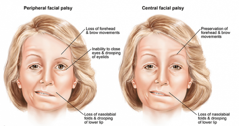 Bells palsy central and periferal 1 - Philadelphia Holistic Clinic