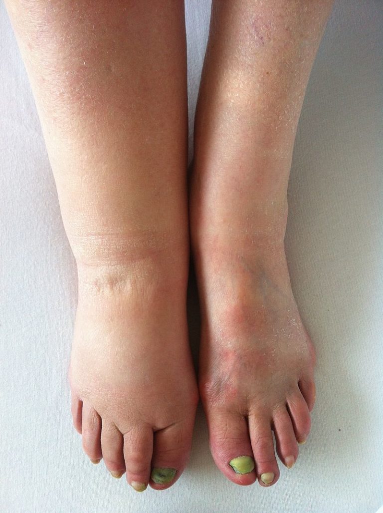 Lymphedema general - Philadelphia Holistic Clinic Lymphedema general - Philadelphia Holistic Clinic