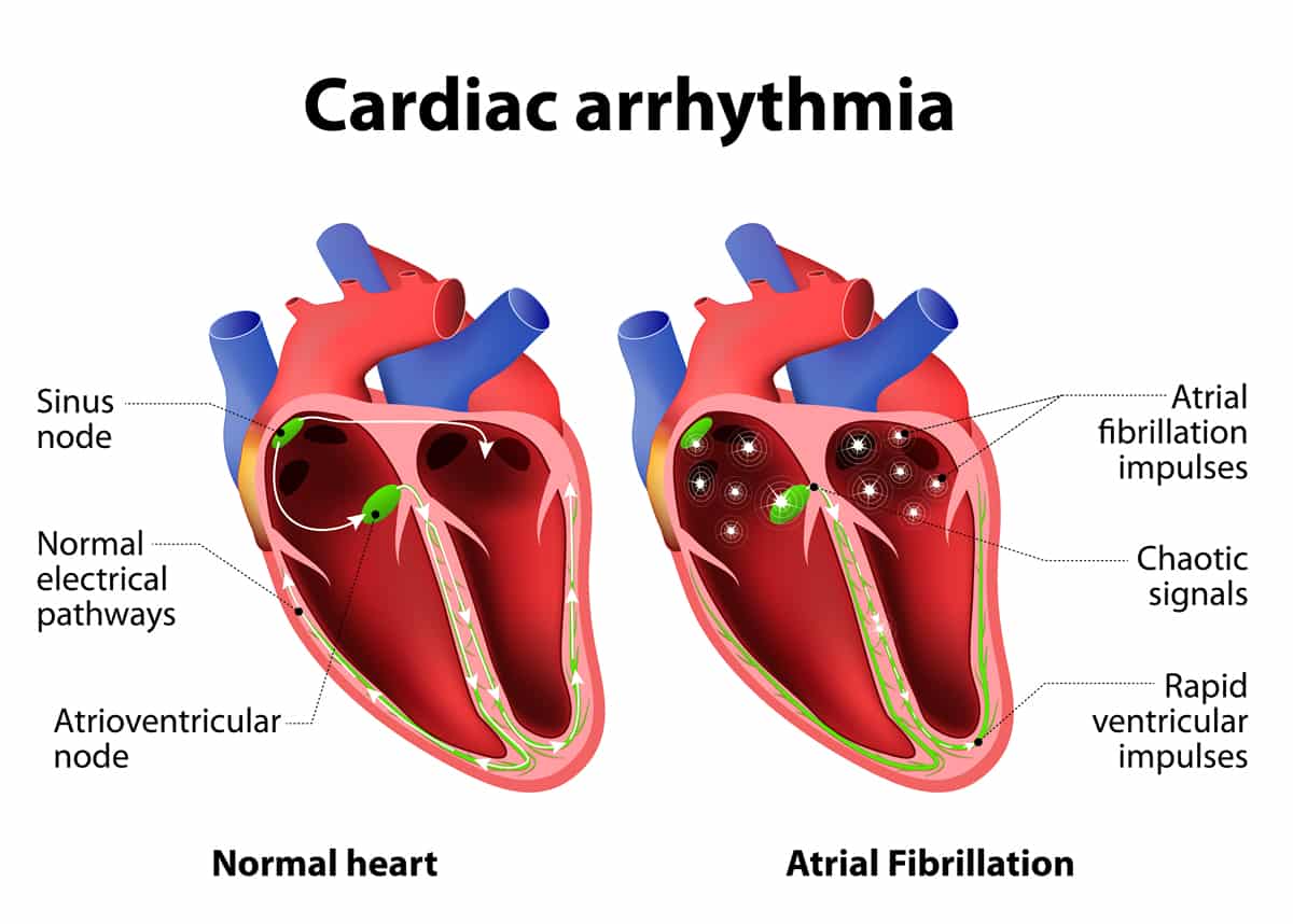 Arrhythmia: Causes and Treatments - Philadelphia Holistic Clinic - Dr ...