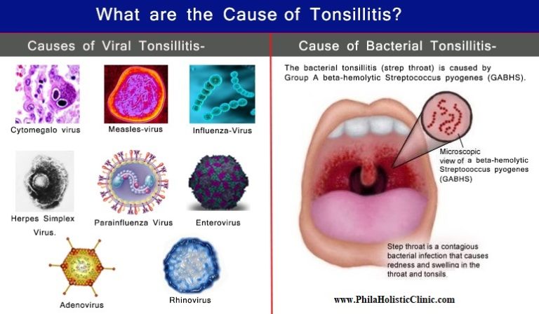 Treatment of Tonsillitis - Philadelphia Holistic Clinic - Dr. Tsan ...
