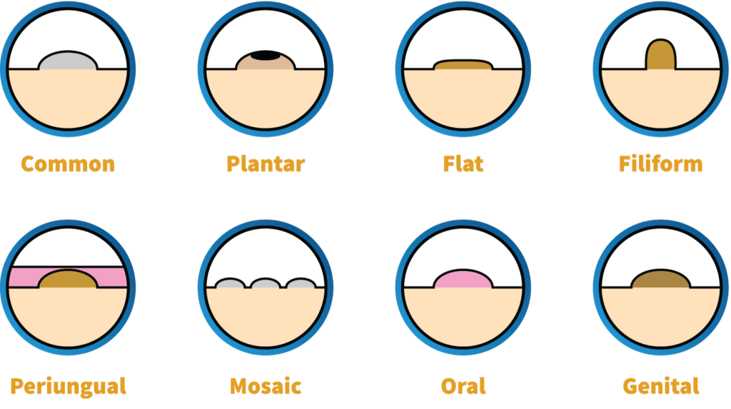 Warts Removal Naturally - Philadelphia Holistic Clinic - Dr. Tsan & his ...