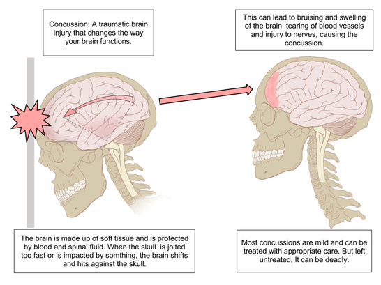 Treatment for Post-Concussion Syndrome - Philadelphia Holistic Clinic