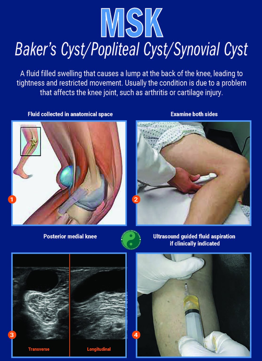 Baker's Cyst: Causes, Symptoms, Western and Holistic Treatments ...